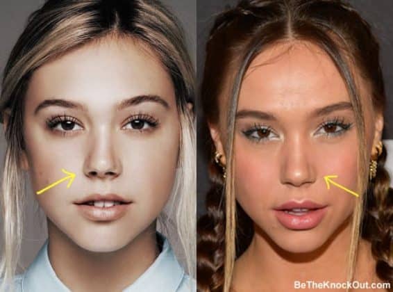 Alexis Ren Plastic Surgery Comparison Photos