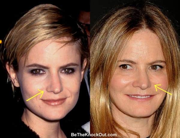 Jennifer Jason Leigh Plastic Surgery Comparison Photos