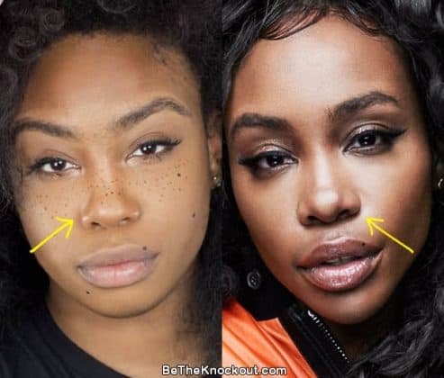 SZA Plastic Surgery Comparison Photos