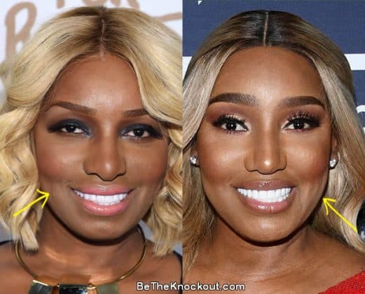 Nene Leakes Plastic Surgery Comparison Photos