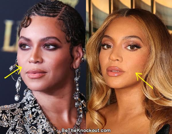 Beyonce Plastic Surgery Comparison Photos