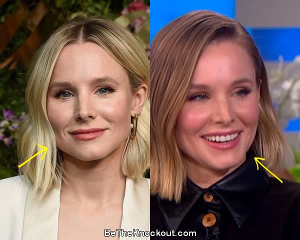 Kristen Bell Plastic Surgery Comparison Photos