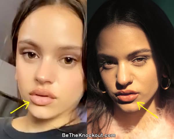 Rosalia Plastic Surgery Comparison Photos